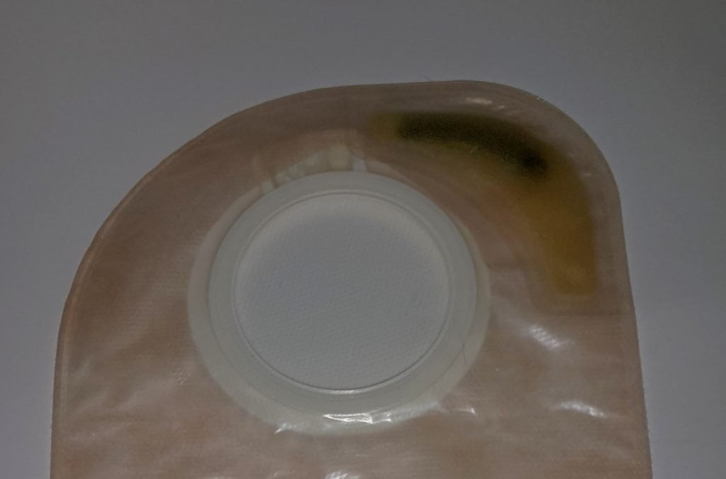 Ostomy Pouch Ballooning | VeganOstomy